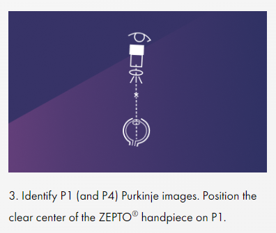 Introducing Zepto®, A New System Added For Cataract Surgery - Naples ...
